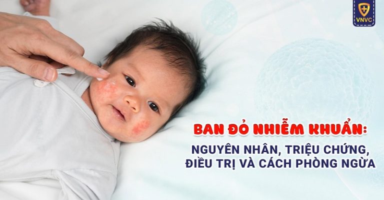 Ban đỏ nhiễm khuẩn: Nguyên nhân, triệu chứng, điều trị và cách phòng ngừa