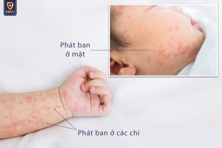 Ban đỏ nhiễm khuẩn: Nguyên nhân, triệu chứng, điều trị và cách phòng ngừa