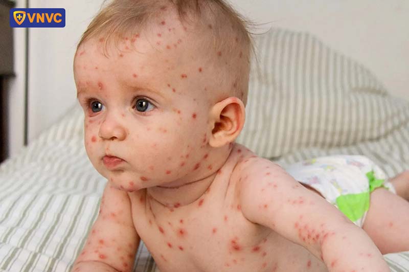 Bệnh thủy đậu ở trẻ em: Triệu chứng, nguyên nhân và phòng ngừa