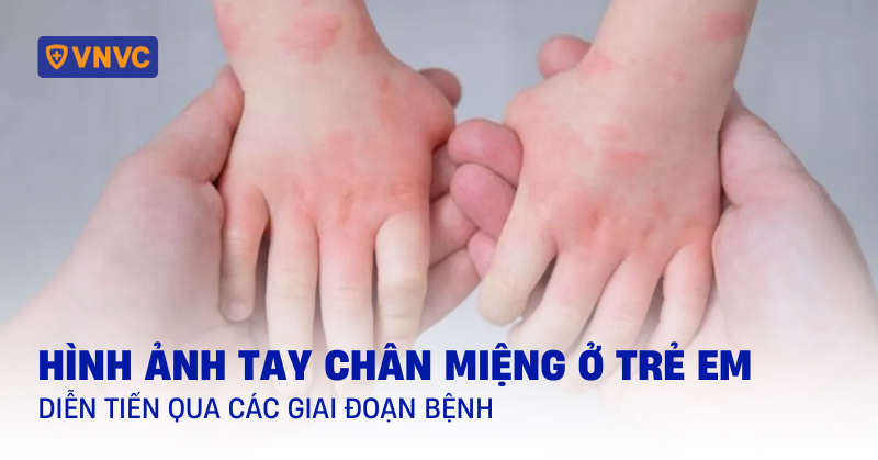 20 hình ảnh tay chân miệng ở trẻ em diễn tiến qua các giai đoạn bệnh