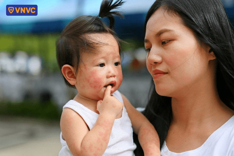 20 hình ảnh tay chân miệng ở trẻ em diễn tiến qua các giai đoạn bệnh